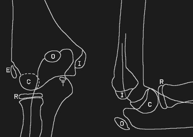 ON - RADIOLOGY: Elbow ossification centers mnemonic in a child